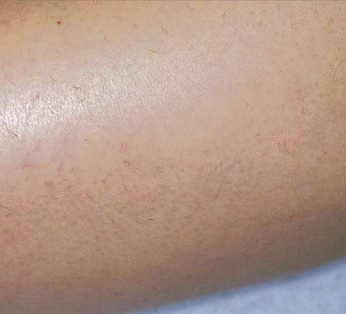 APILUS : l'épilation électrique définitive - ESTHE-TIME